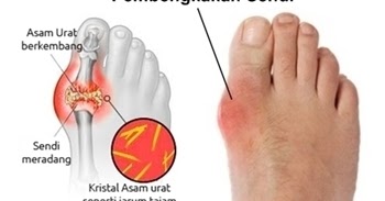 hydro c: Kadar dan Cara Mengatasi Asam Urat