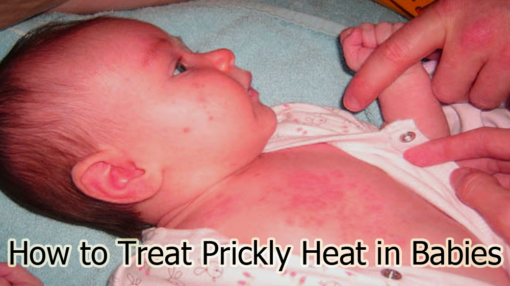 How to Treat Prickly Heat in Babies