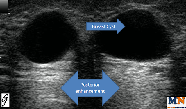 MedicoNotebook: Posterior acoustic shadowing and enhancement