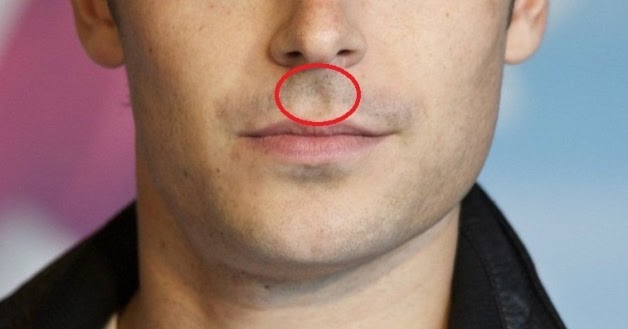 Long Philtrum Female & Male Causes, Surgery|Celebrities with Long ...