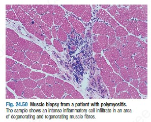 What are the Diagnostic criteria of polymyositis?