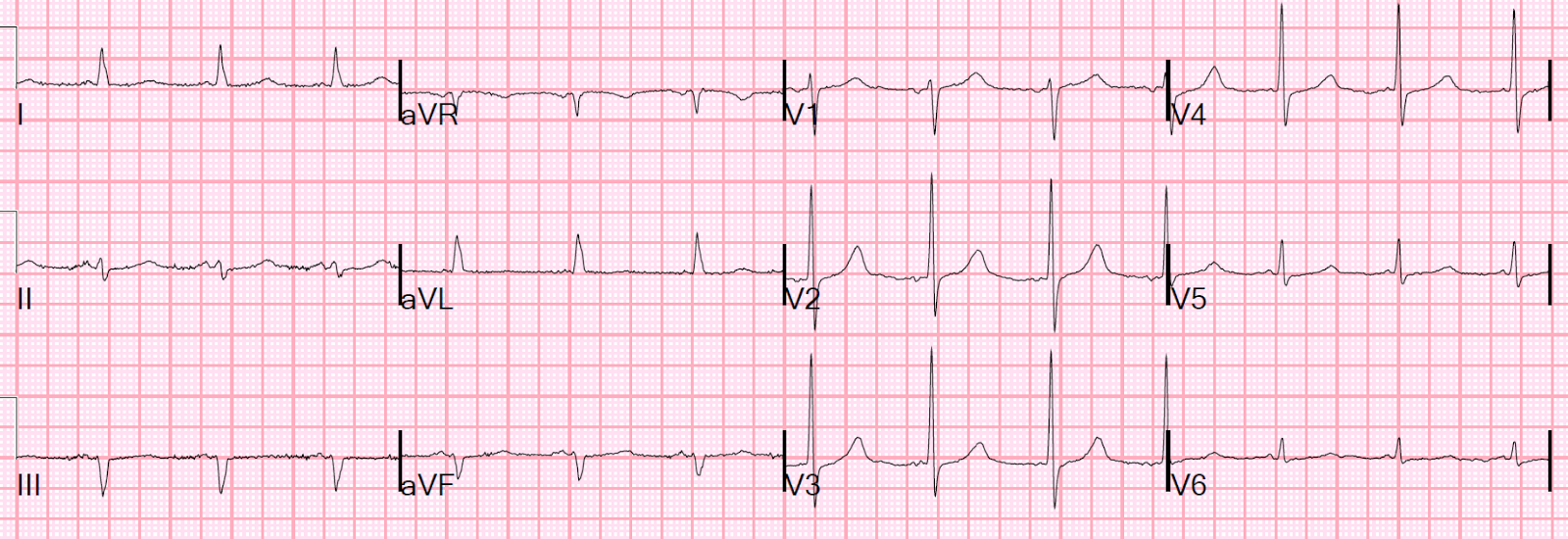Dr. Smith's ECG Blog: Atrial fibrillation with RVR: use POCUS to assess ...