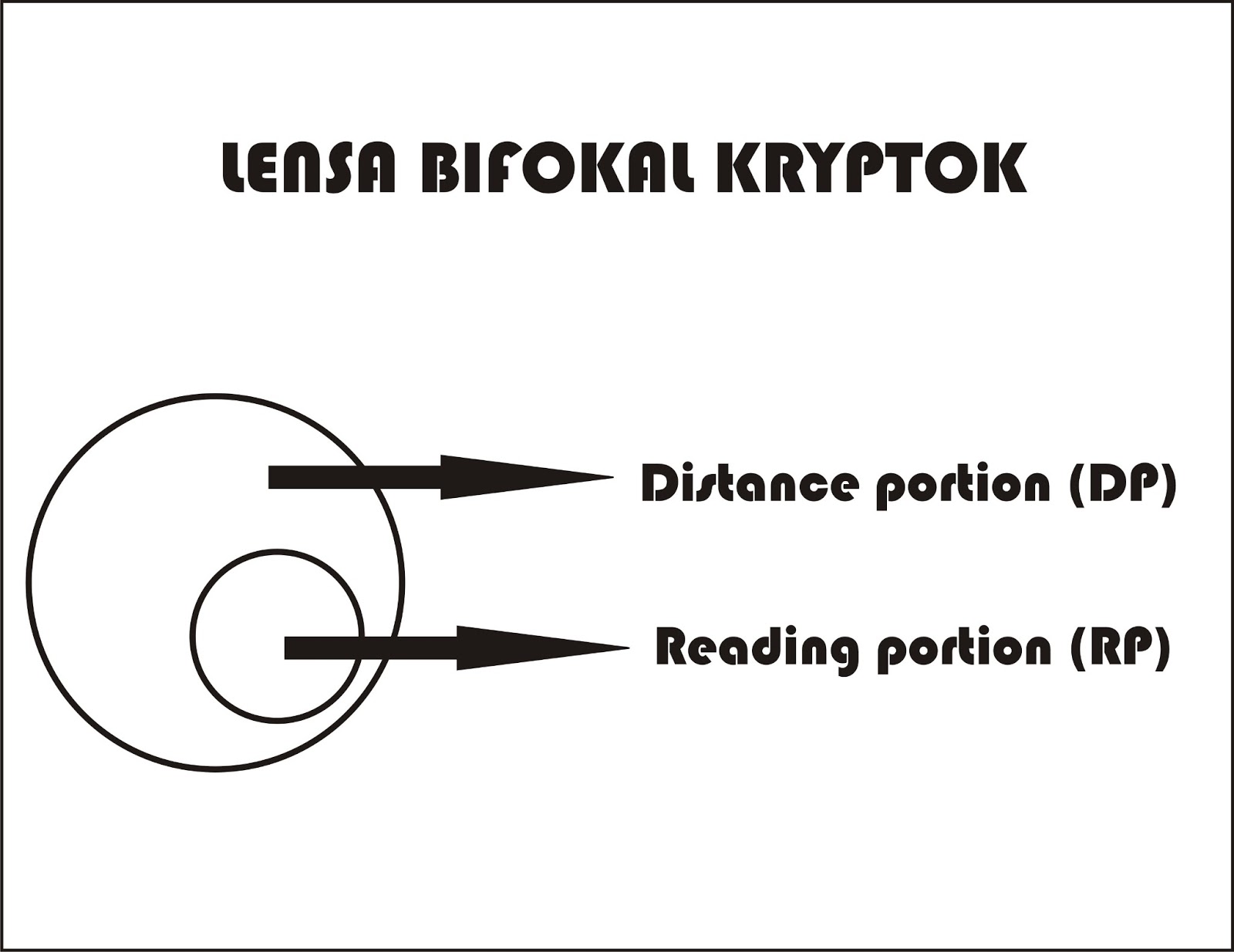 aryani's world: Keunggulan dan kelemahan berbagai jenis lensa bifokal