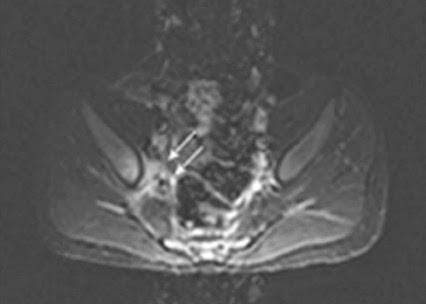 ESPE 203-2013: Plexo Sacro y patologías asociadas