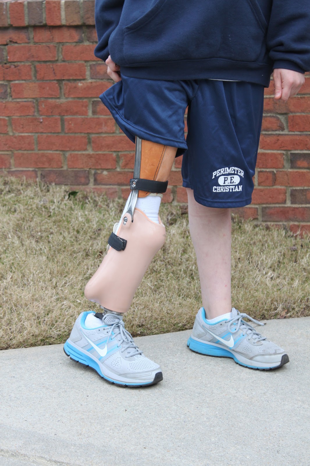 Leaving It All On The Field: Rotationplasty Prosthetic Leg...The Final ...