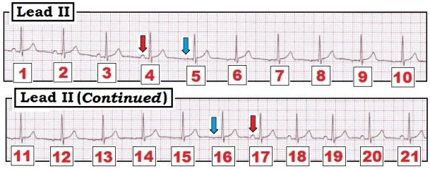 ECG Interpretation: ECG Blog #65 (AFib - RVH - Wandering - MAT)