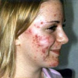 Acne: a brief introduction | AcneBook