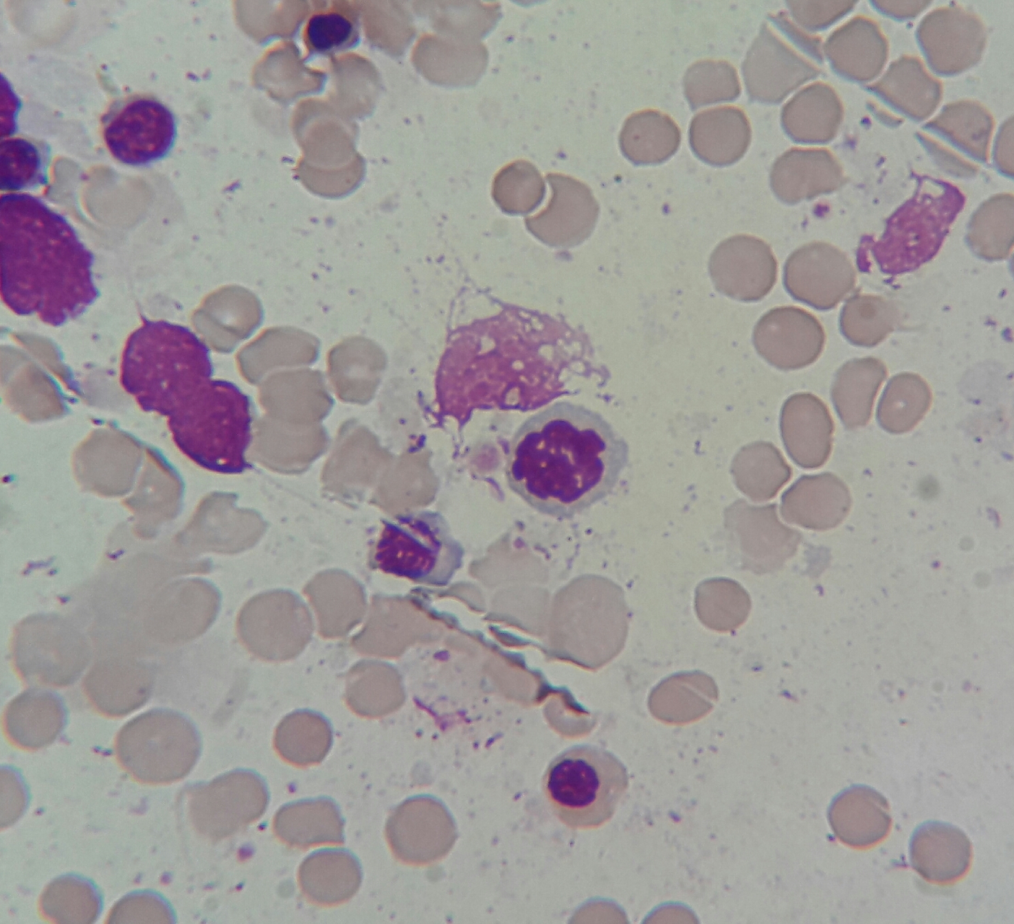 into the roots: Erythroid dysplasia