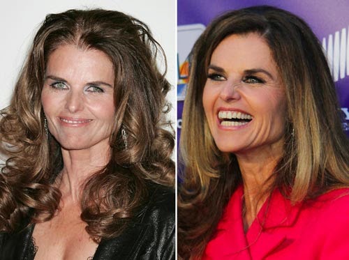 Dr. Plastico: Maria Shriver Plastic Surgery Before & After