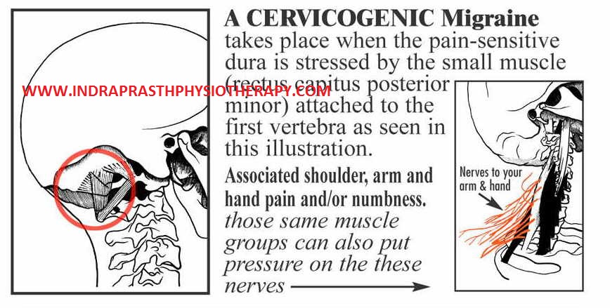 INDRAPRASTH PHYSIOTHERAPY CENTRE: CERVICOGENIC HEADACHE