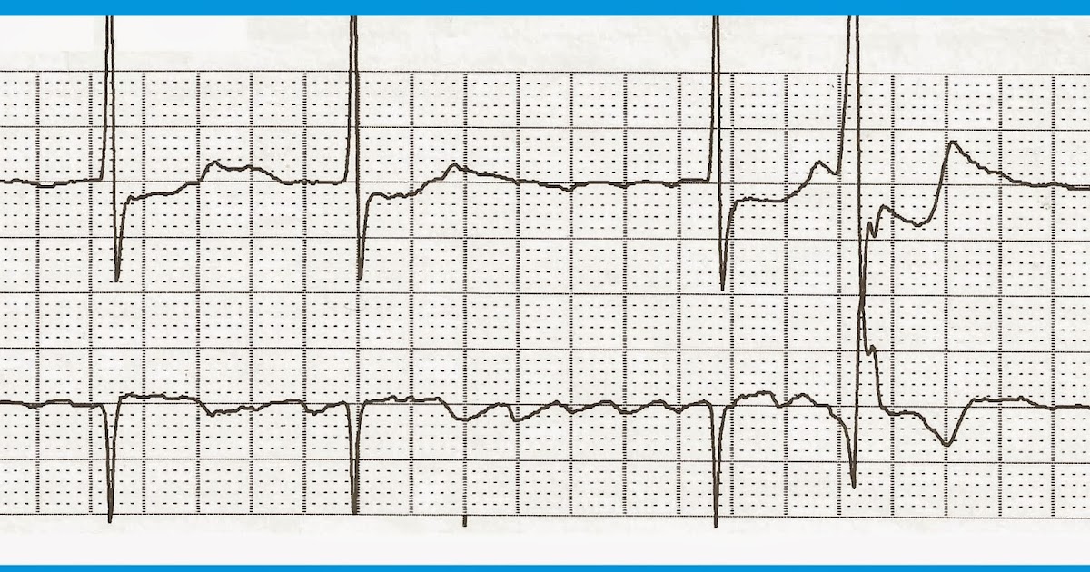 Float Nurse: Practice EKG Rhythm Strips 213