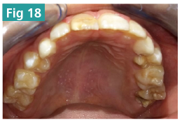 Molar Incisor Hypomineralization (MIH): Conservative Treatment Approach