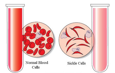 Pediatrics Notes: Diagnosis of Sickle Cell Disease