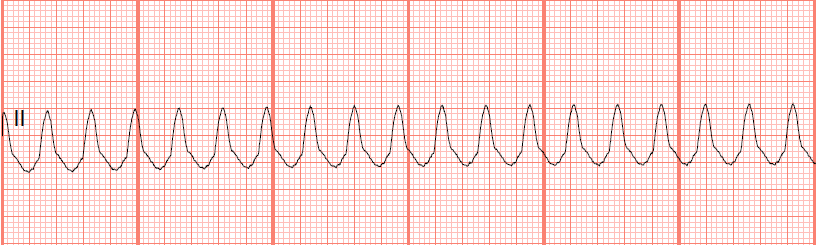 Basic EKG Test 71