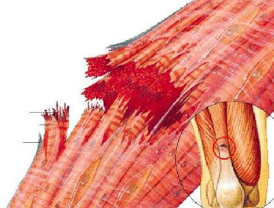 Naturally treat a muscle tear