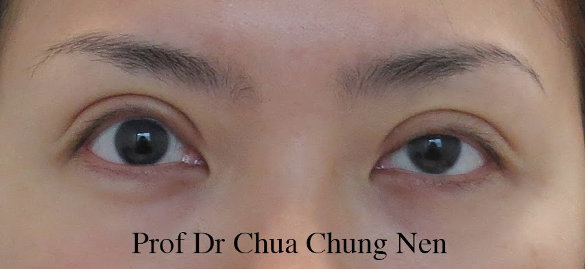 Eyelid Surgery by Prof Dr CN CHUA 蔡鐘能: October 2014