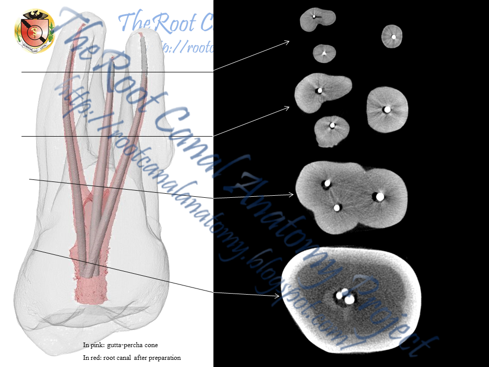 The Root Canal Anatomy Project: Conservative Endodontic Access ...