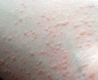 Penyebab Biduran dan Cara Mengobati Biduran | Google Coconut