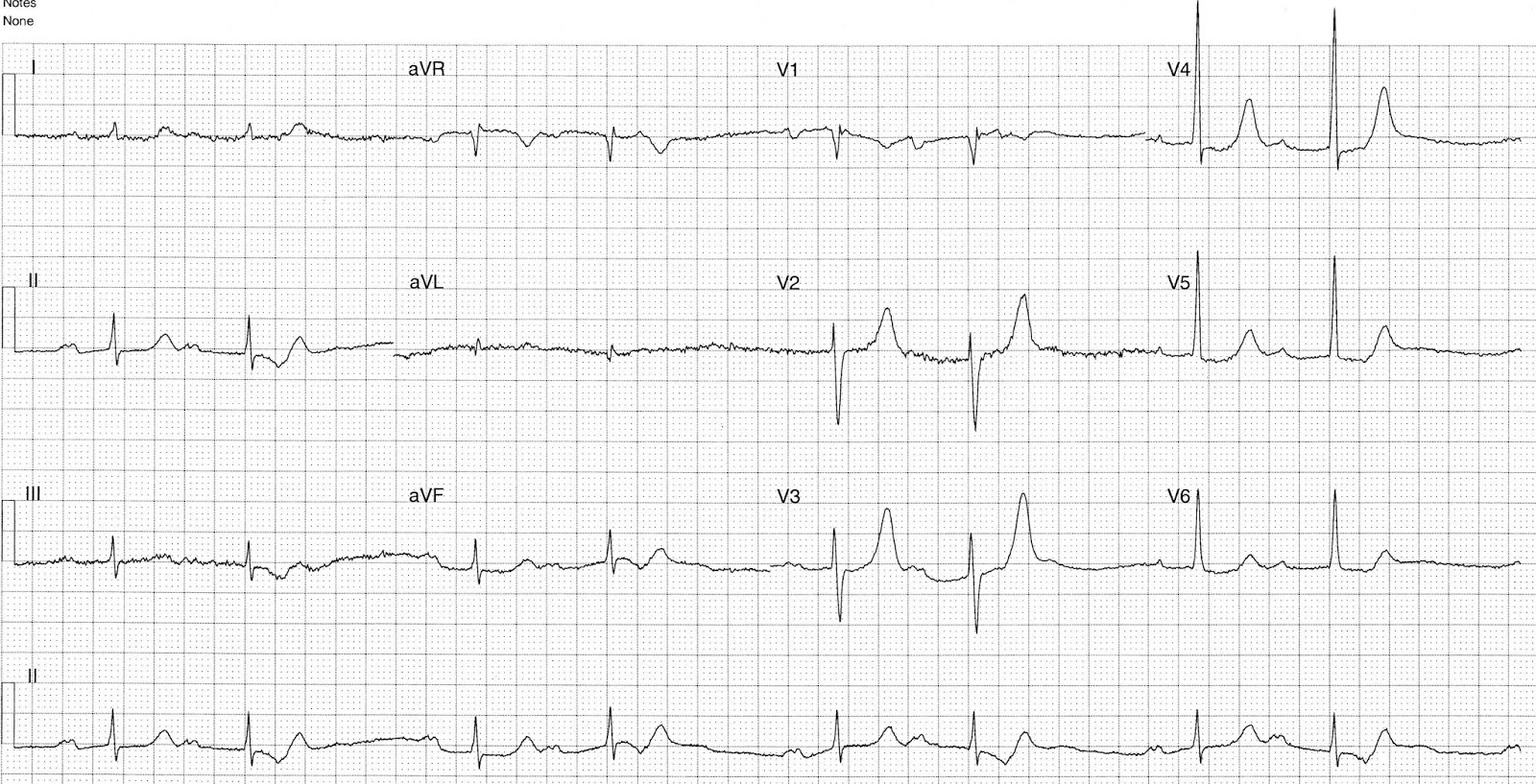 Wenckebach Ekg