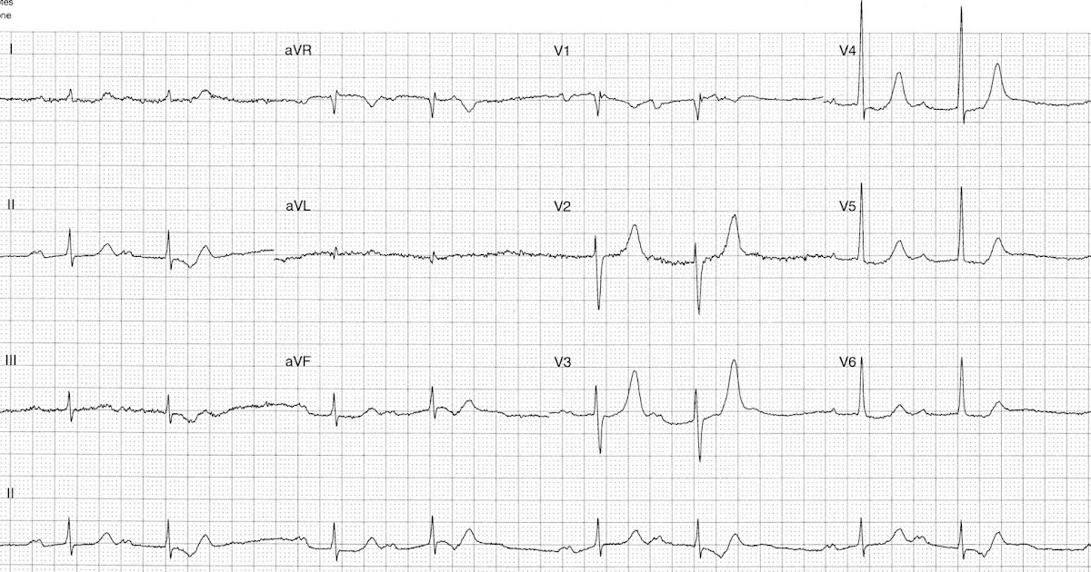 ECG of the Week: ECG of the Week - 23rd January 2016 - Interpretation