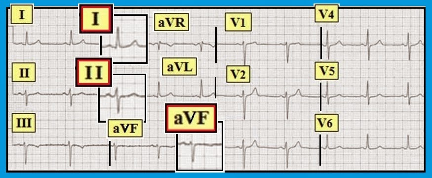 ECG Interpretation: ECG Blog #203 (ECG MP-20,21) — AXIS & Hemiblocks ...