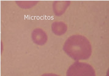 Fichero de Hematología: Anormalidades Eritrositarias.