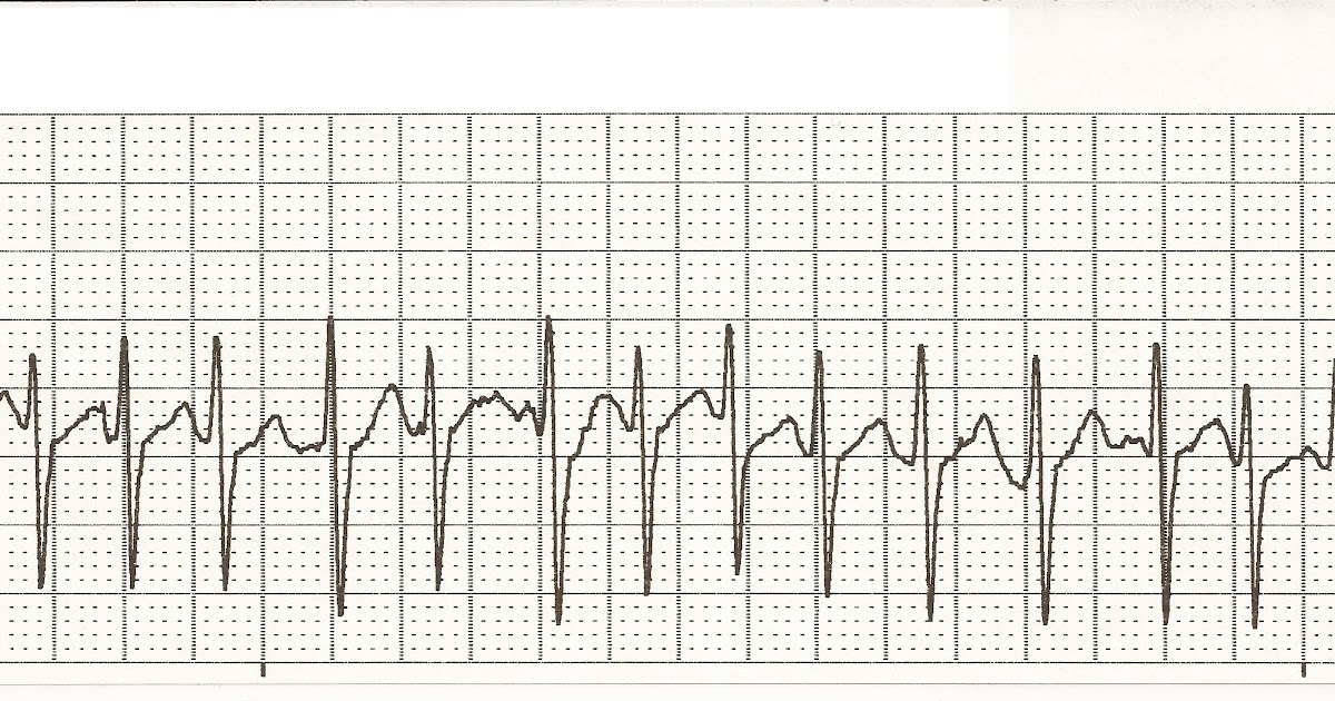 Identify the pharmacologic therapy for the following rhythms.