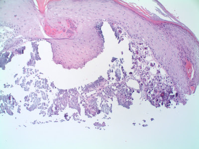 Dermatopathology: Subepidermal calcified nodule