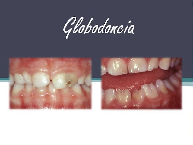 DENTAL 1001 UNAM: Macro y Microdoncia, y otras Anomalías Dentales ...