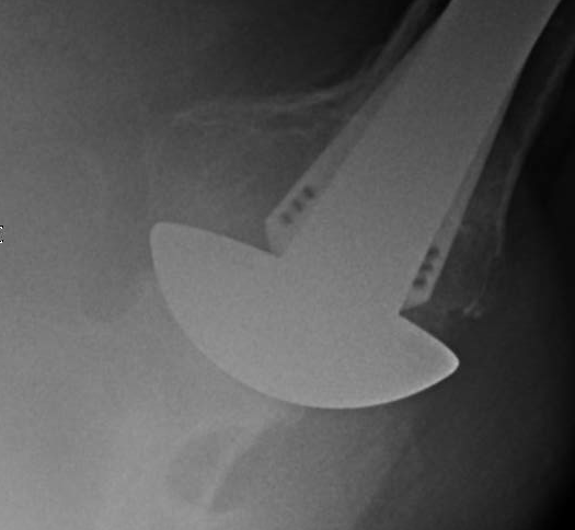 Shoulder Arthritis/Joint Replacement Rotator cuff tears: Ream and run ...