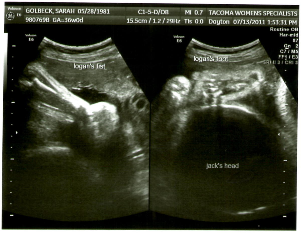 The Golbecks: 36 weeks . Last Ultrasound for growth