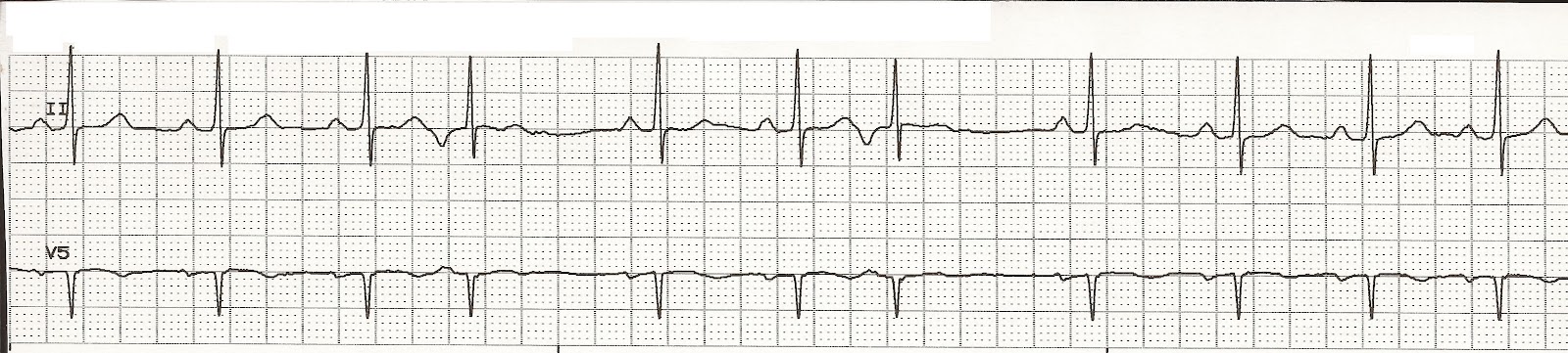 EKG Rhythm Strip Quiz 49