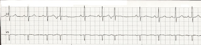 EKG Rhythm Strip Quiz 49