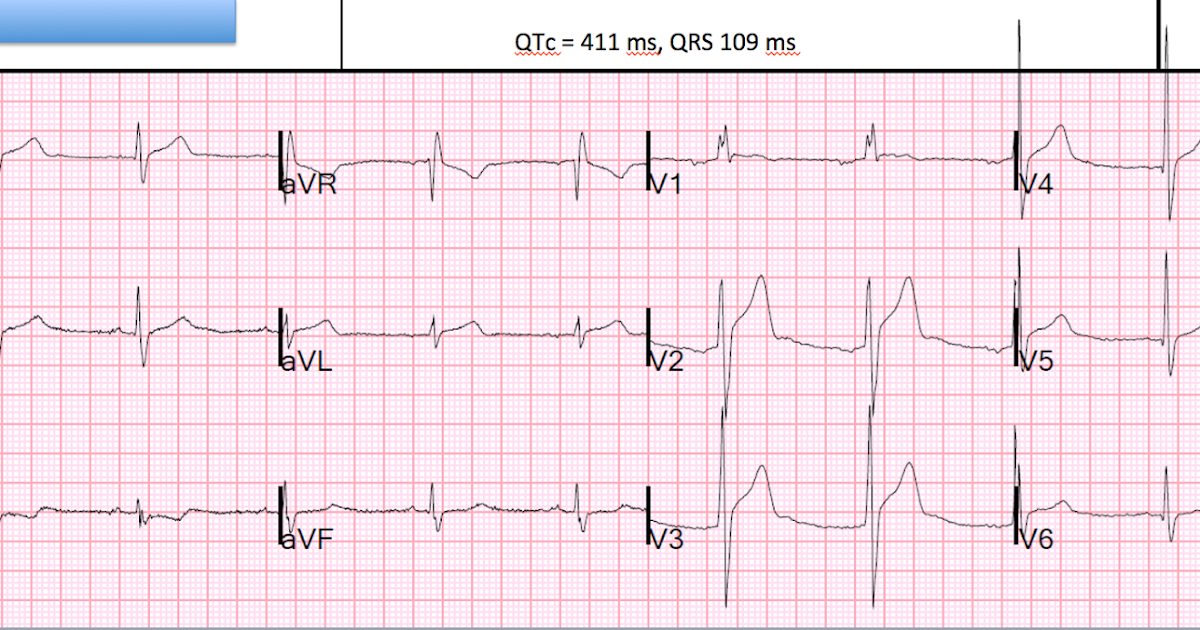 Dr. Smith's ECG Blog: Early Repolarization, Anterior MI, or Other?