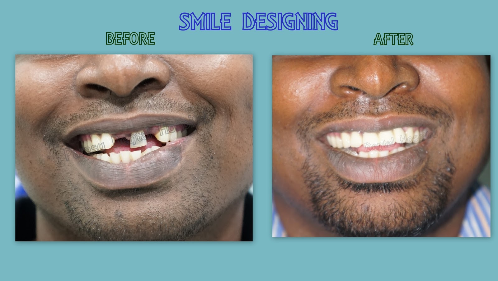 Dental Xray center in medavakkam: Best Smile Designing in Chennai ...