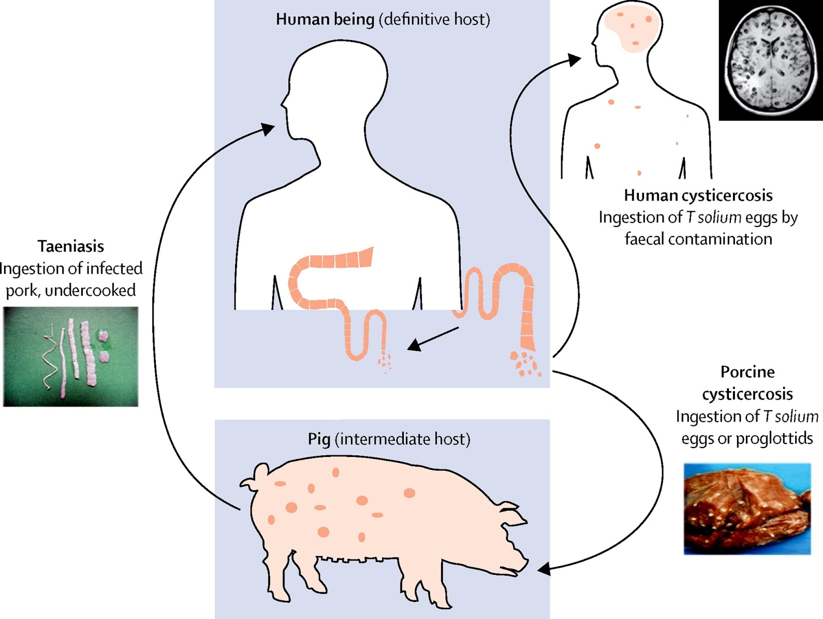 BSN Notes: Neurology- Neurocysticercosis | notes.nursium.com