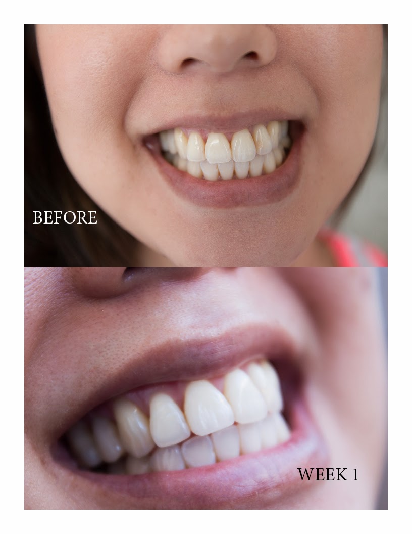 Dress Yourself Happy By Serein: Get Your Whitest Teeth EVER!