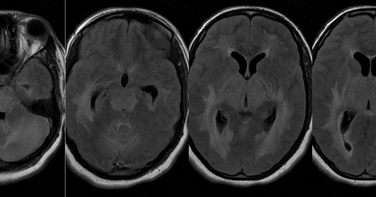 Dr Balaji Anvekar FRCR: Japanese encephalitis MRI