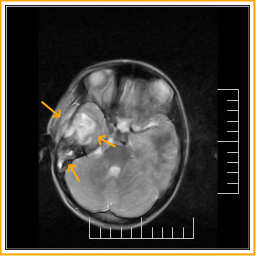 Complicated Mastoiditis-MRI - Sumer's Radiology Blog