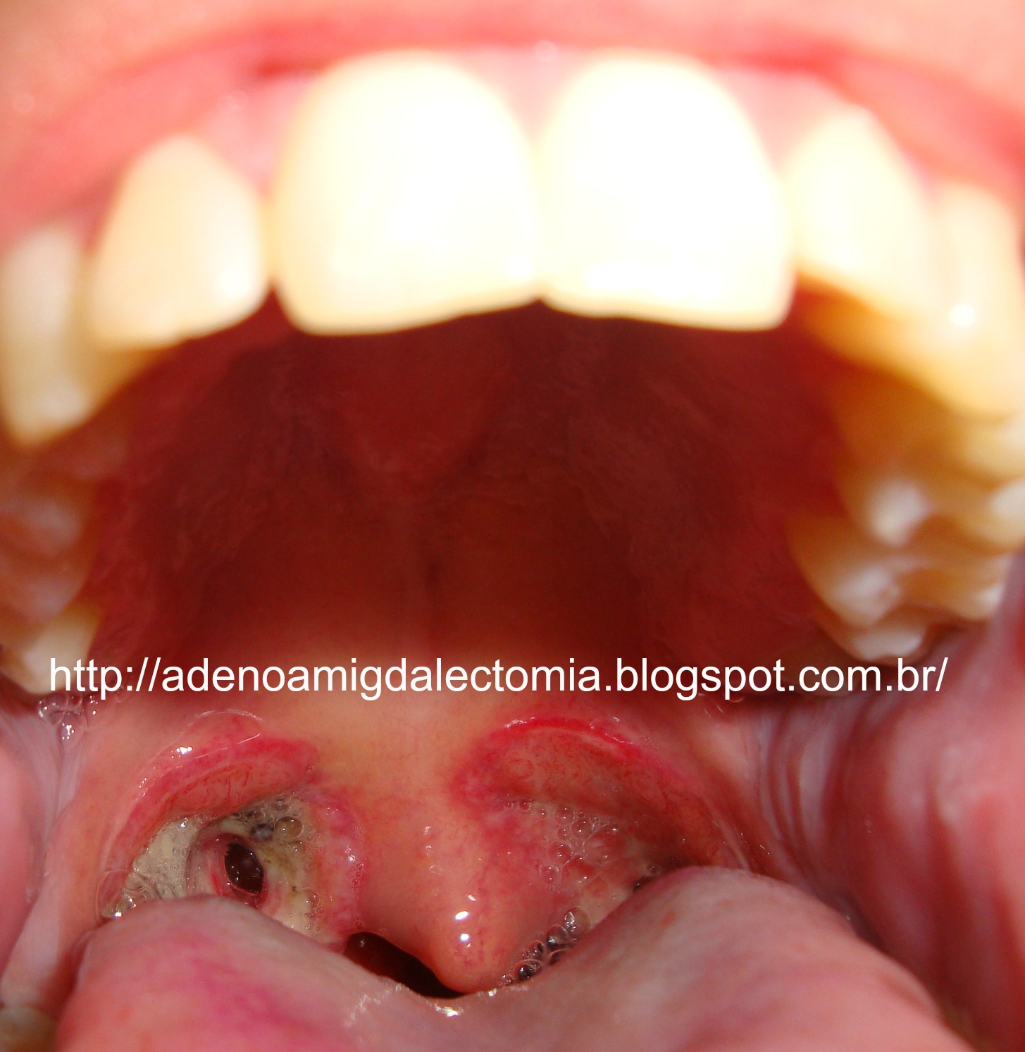 Adenoamigdalectomia: Foto Adenoamigdalectomia: Nono Dia