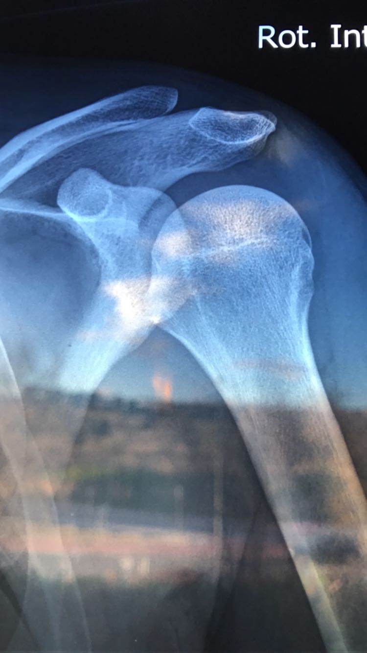 Subluxación acromioclavicular