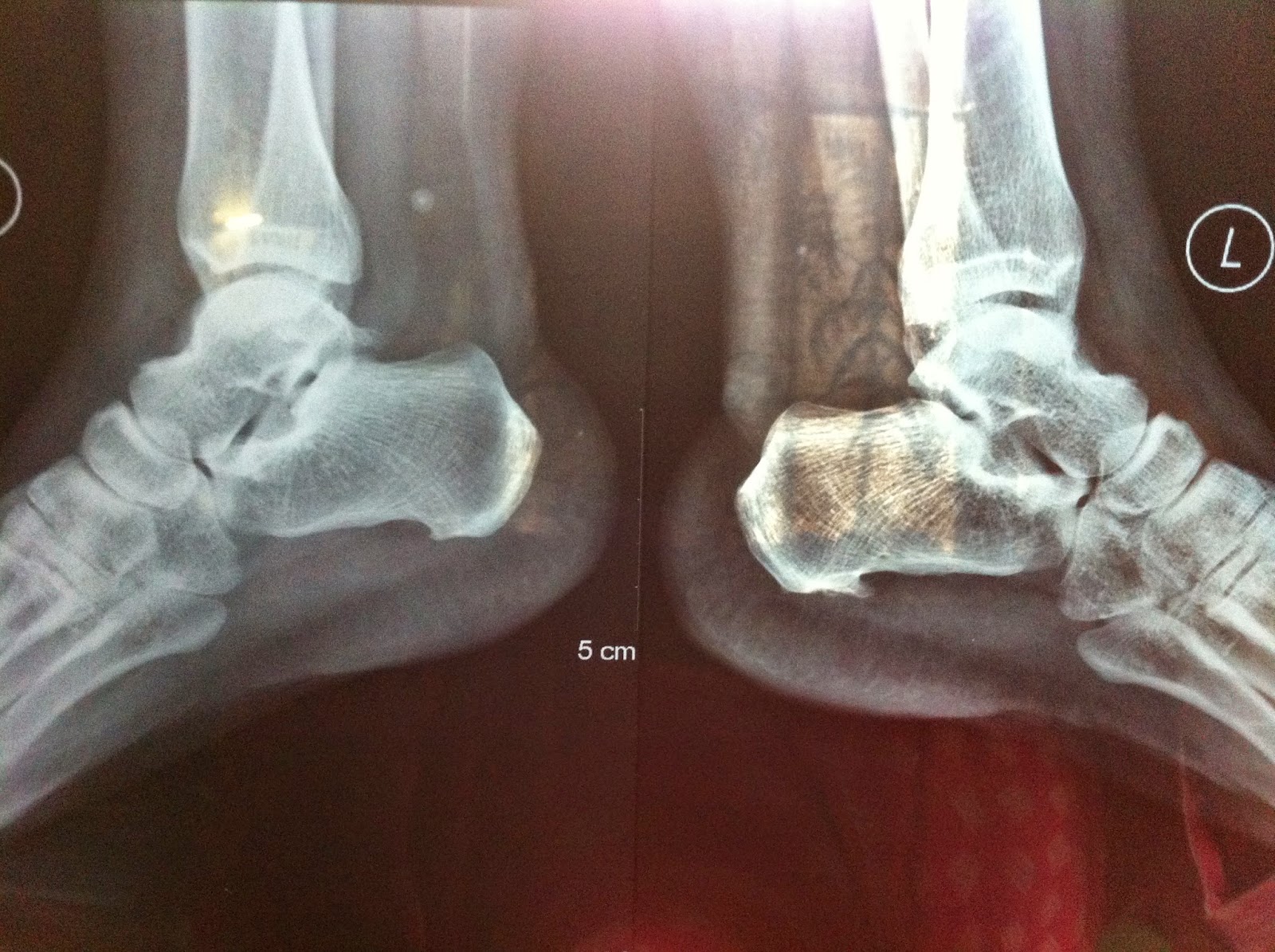 Antara Benjolan, Tumor dan Kanker: Tulang Liar di Telapak Kaki