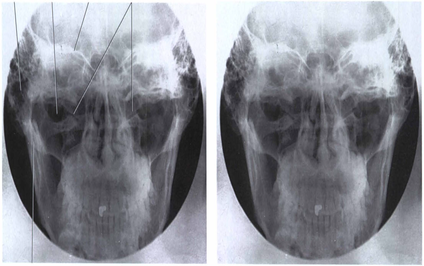 TEKNIK RADIOGRAFI CERVICAL: November 2018