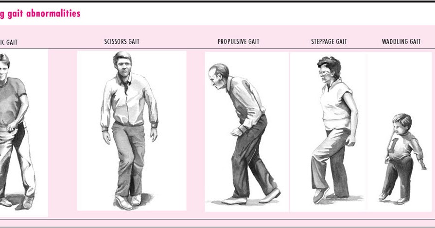 FISIOTERAPI: Scissors Gait