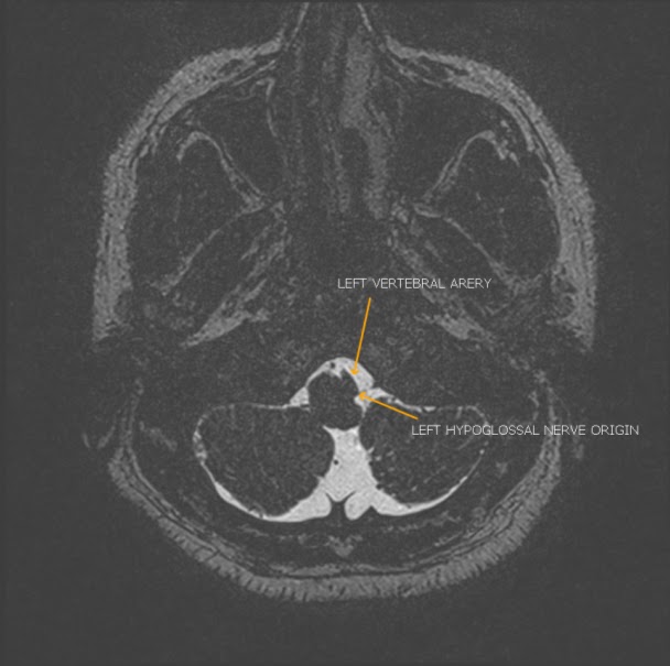mricases: Isolated hypoglossal nerve palsy due to a tortuous vertebral ...