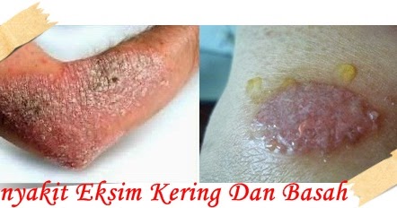 obat gatal kulit eksim kering | Ciri - Ciri Penyakit Eksim dan ...