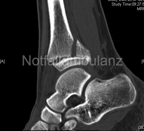 Brennpunkt Notaufnahme: Fall 16: Kindliche Distorsion des OSG: Triplane ...