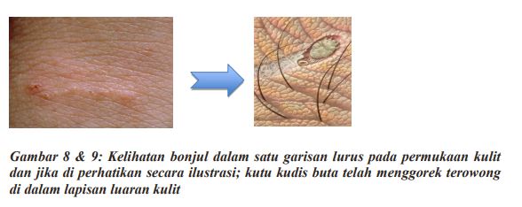 Cara Atasi Penyakit Kudis Buta