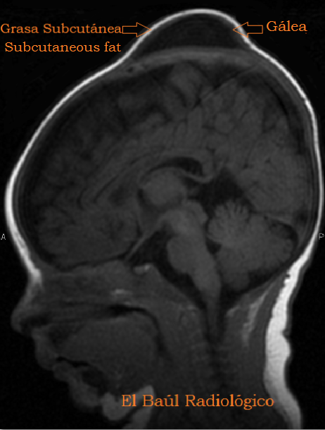 El Baúl Radiológico: 2) HEMATOMA SUBGALEAL: HALLAZGOS EN TOMOGRAFÍA ...