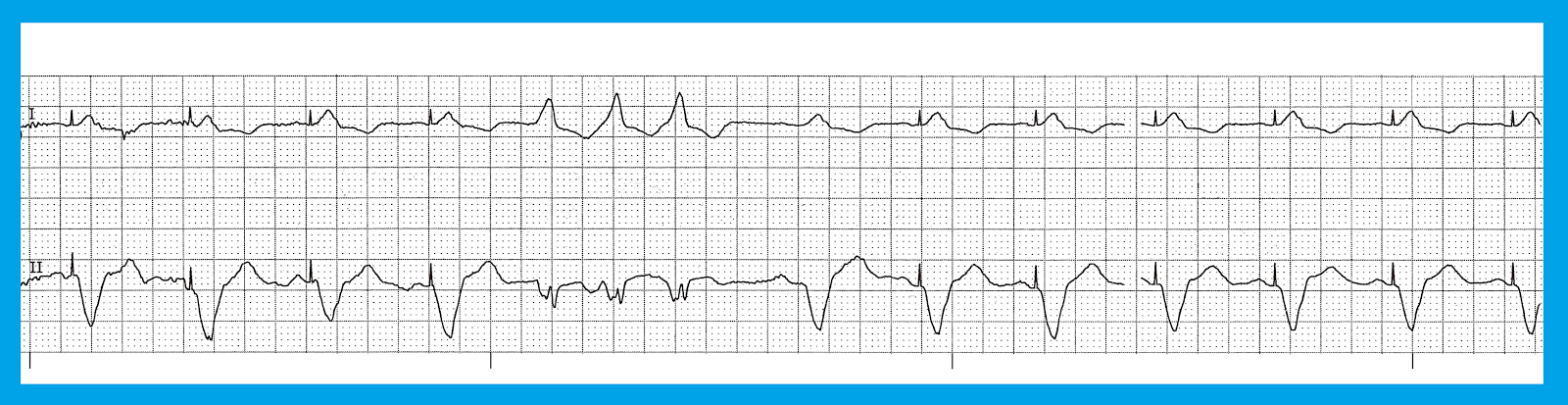 EKG Rhythm Quiz 222